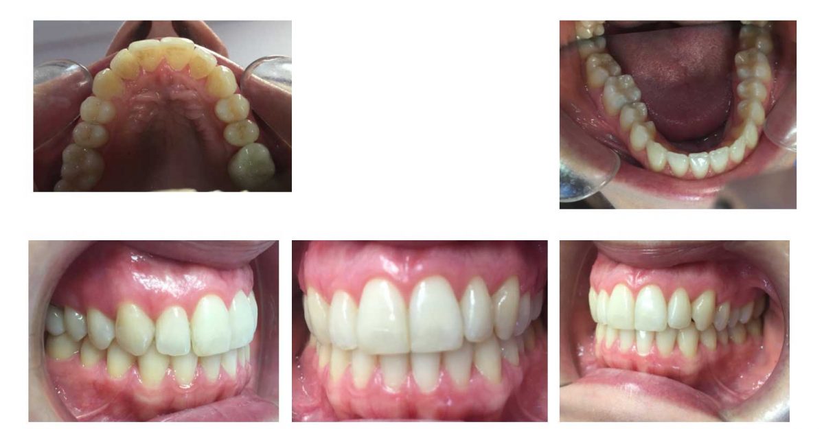 Invisalign Para Arcadas Estrechas Con Mordida Irregular - Dra. Sara Gil